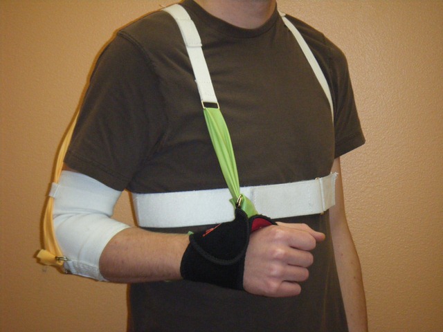 Dynamic sling to support UE post brachial plexus injury to return to active lifestyle - running